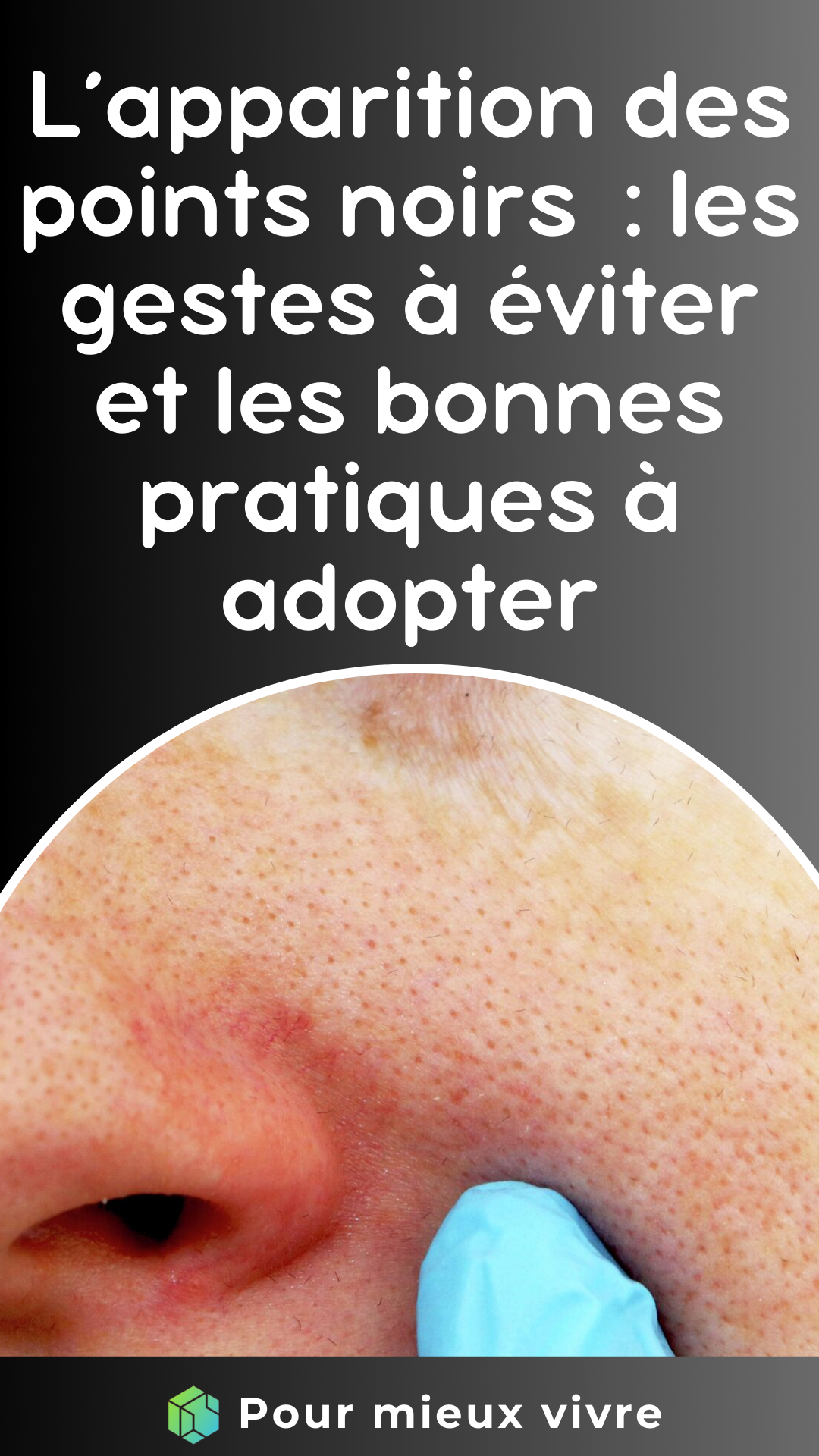 Points Noirs : Conseils et Erreurs à Éviter pour une Peau Saine - Pour ...